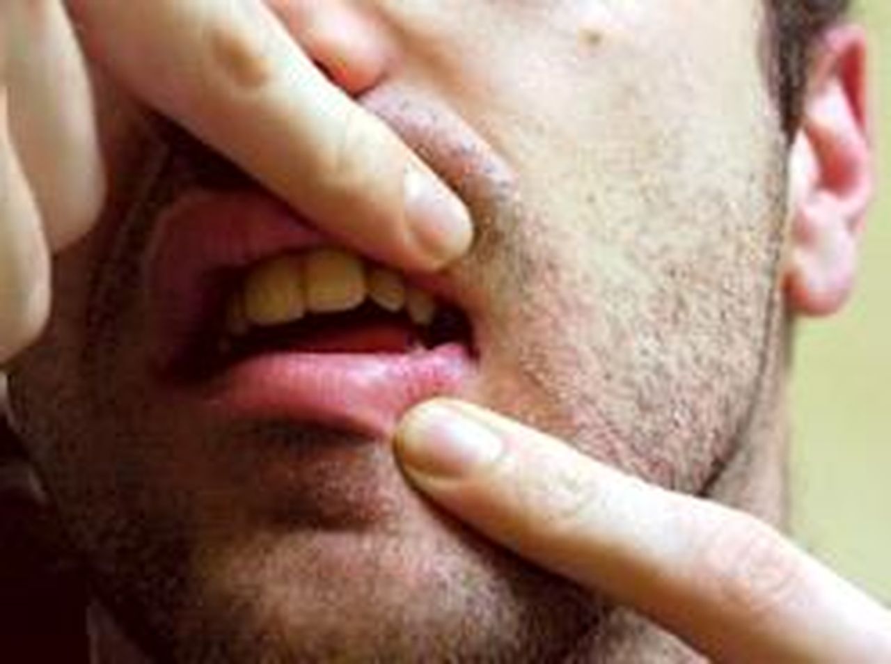 Herpes Dentro De La Boca Leve